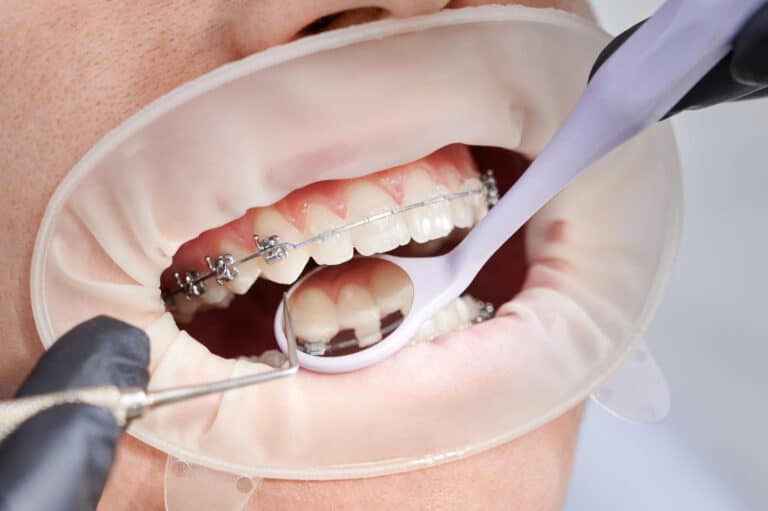 Stages of Dental Braces Treatment | Dr. James L. Pelletier